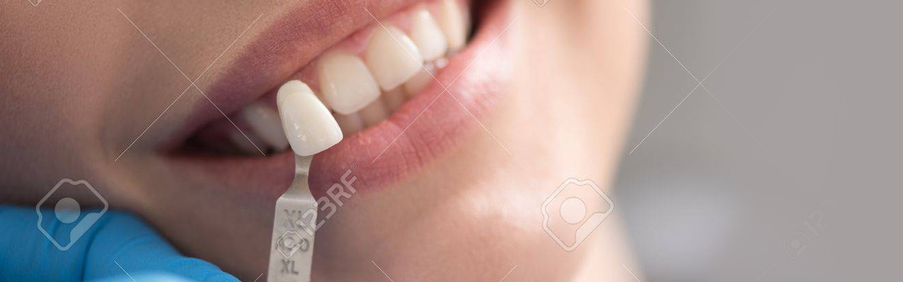 Teeth Whitening | Lee Dentist | Lee Dental Practice